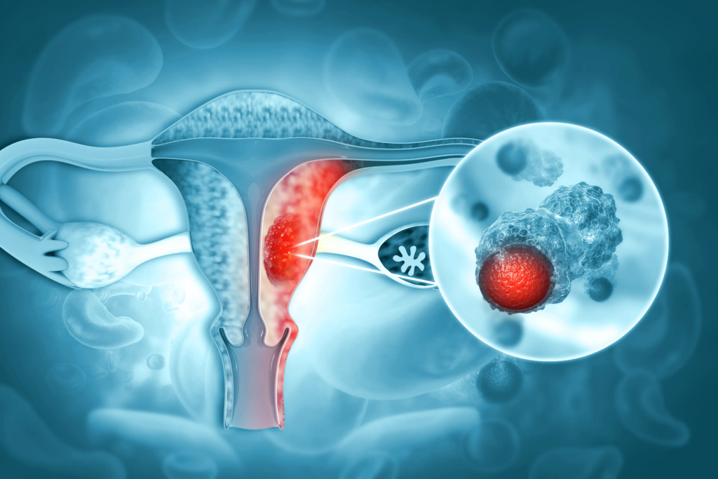 Cáncer de endometrio: el enemigo silencioso que afecta a miles de ...